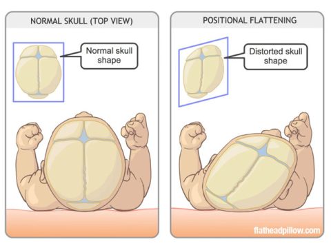 Flat Head (Plagiocephaly) - Baby Doctor