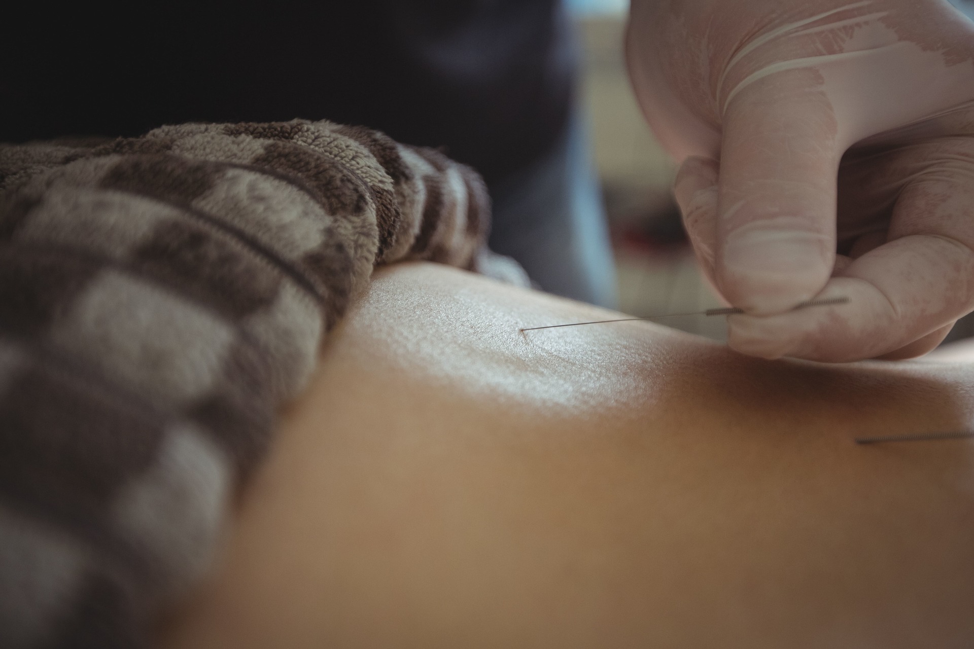 Acupuncture - Baby Doctor